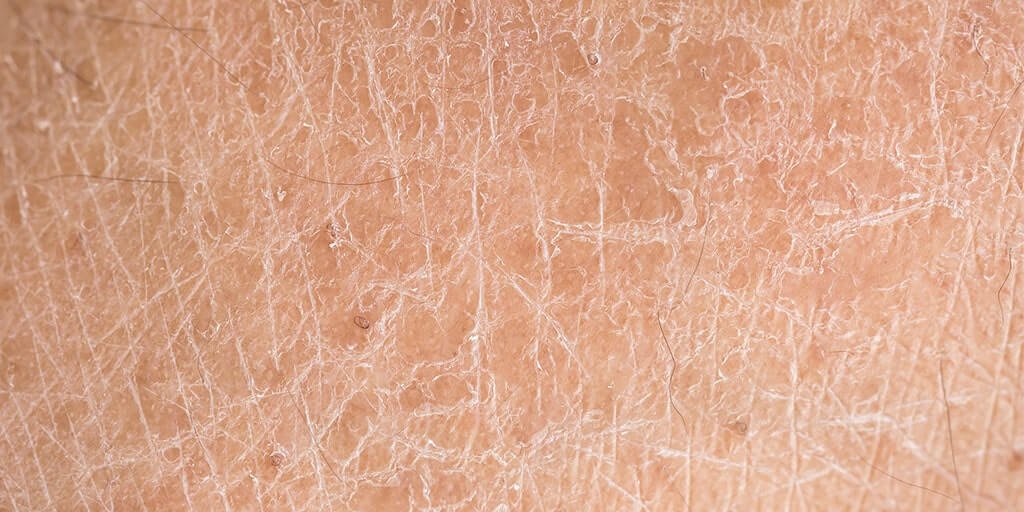 Piel seca vs. eczema atópico : causas, tratamientos y productos de La ...