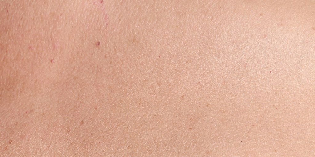 Qué es la atopia: síntomas, causas y tratamientos | La Roche Posay